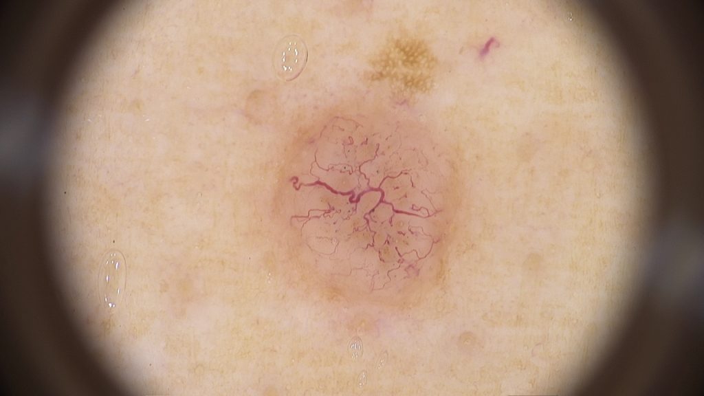 Basaliom – Bosch & Bosch