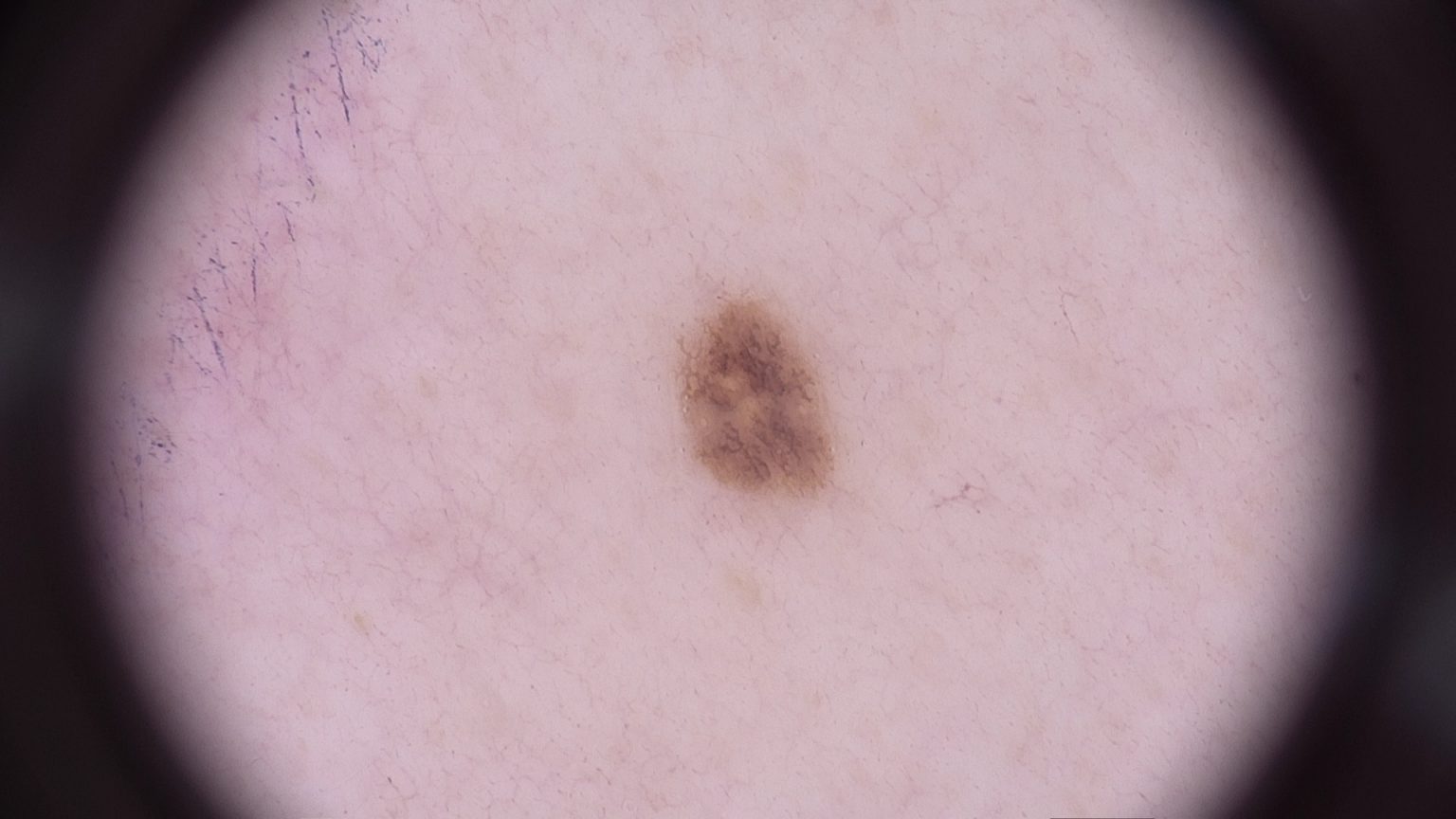 Verändern sich auch gutartige Muttermale ? – Bosch & Bosch